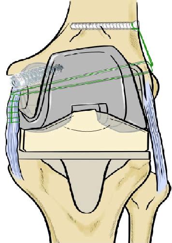 Figure 1 From Modified Mcl Indentation Technique In Total Knee