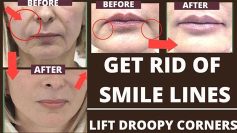 Get Rid Of Smile Lines Nasolabial Folds Lift Up Droopy Corners Of The Mouth Face Yoga