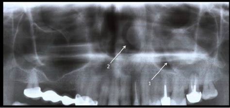 9 Soft Tissue Calcification And Ossification Flashcards Quizlet