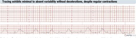 Figure 2 5 From Intrapartum Management Of Category Ii Fetal Heart Rate