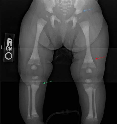 Lower Extremity X Ray Obtained As Part Of Skeletal Survey Image Shows