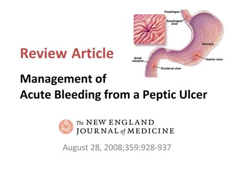 Peptic Ulcer Bleeding Ppt