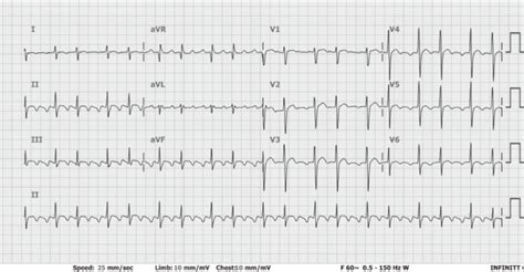 Resting Electrocardiography Showed Typical Atrial Flutter With 2 1 Or Download Scientific