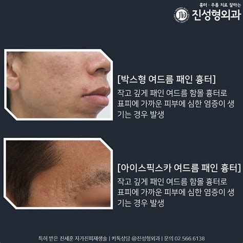 진성형외과 자가진피재생술 여드름흉터 치료 비싸기만하고 시술 효과를 보지 못했다면 움푹