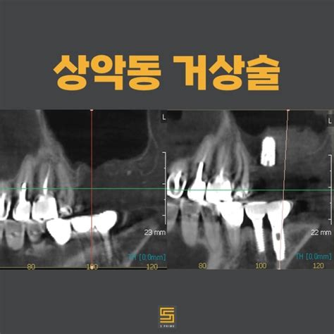 고난이도 임플란트 상악동거상술 문제 없습니다 네이버 블로그