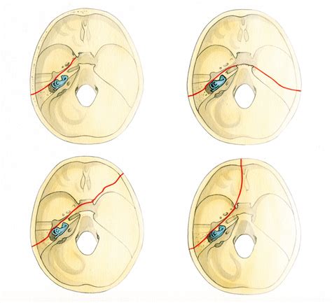 Basal Skull Fracture Explanation At Frances Chavez Blog