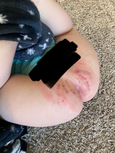 Yeast Diaper Rash Candida Diaper Dermatitis Symptoms 56 Off