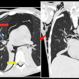 Axial CT A And Coronal Reformatting B Evidenced Pneumomediastinum