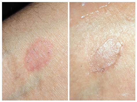 Is My Ringworm Improving Rmedicaladvice