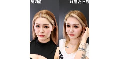 【糸リフト×くまとり】更に綺麗にを叶える小顔整形｜症例写真・ビフォーアフター｜美容整形･美容外科のtaクリニックグループ
