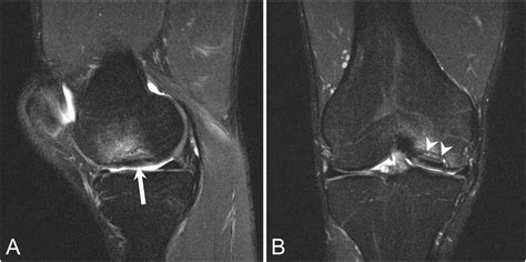 Cartilage Injury Patterns In The Professional Athlete Journal Of