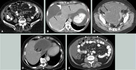 Morphological Patterns Of Pmp Appendiceal Primary Tumor Asterisk