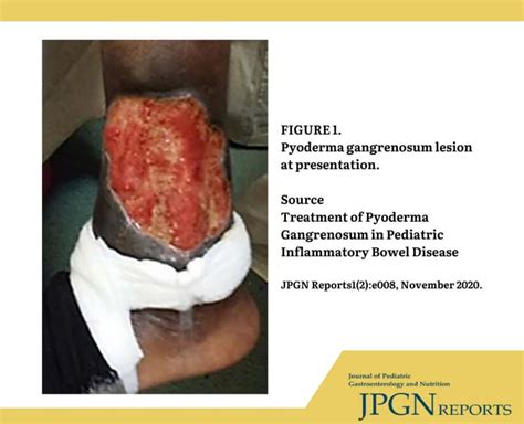 Pyoderma Gangrenosum Ibd