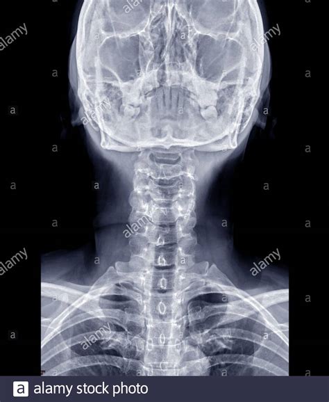 X Ray C Spine Or X Ray Image Of Cervical Spine Ap View For Diagnostic Intervertebral Disc
