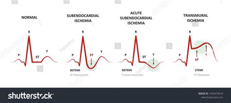 Diagnosis Myocardial Ischemia Nstemi Stemi Ekg Stock Illustration The Best Porn Website