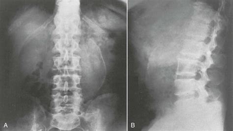 Abdominal Aortic Aneurysm Anesthesia Key