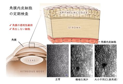 コンタクトで減る目の細胞：「角膜内皮細胞」 たける眼科 福岡市早良区 高取商店街 西新駅／藤崎駅
