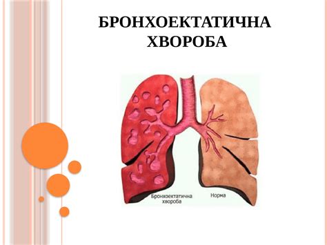 Бронхоектатична хвороба Презентации Внутренние болезни Docsity