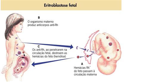 Mãe Nota 10 Eritroblastose Fetal