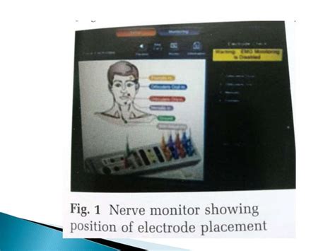 Intra Operative Nerve Monitoring In Ent Pptx First Aid Injuries