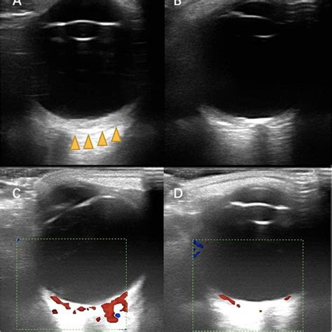 The Ocular B Scan Ultrasonography Showed Diffuse Choroidal