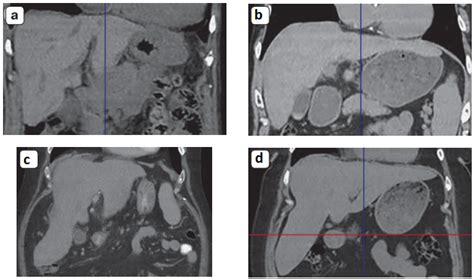 A New Algorithm For Assessing Hepatomegaly Through Ct Scan Of The Abdomen