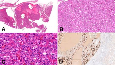 Figure 1 From Tsc Mtor Pathway Mutation Associated Eosinophilic