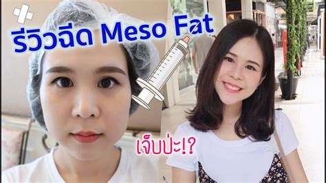 รีวิว ฉีดเมโสแฟต Meso Fat Fat Contour สำหรับคนแก้มเยอะ Eyepolar