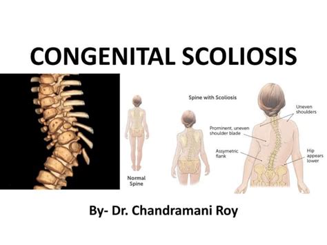 Congenital Scoliosis Pptx Physical Therapy Wellness