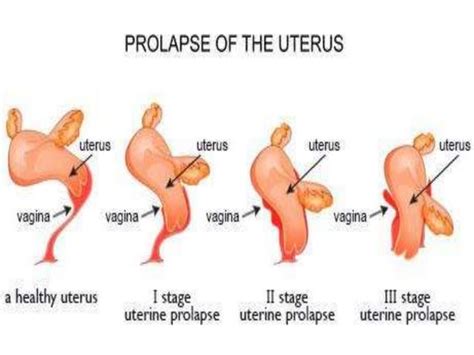 Case Presentation Of Post Menopausal Procidentia Ppt