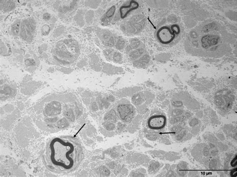 Electron Micrograph Transverse Section Severe Loss Of Myelinated