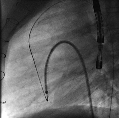 Muscular Amplatzer Vsd Occluder Device Implanted At Subvalvular Download Scientific Diagram