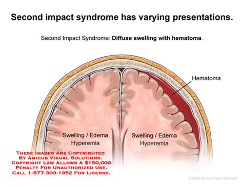 Kinesiology And Sport Review Concussions Second Impact Syndrome