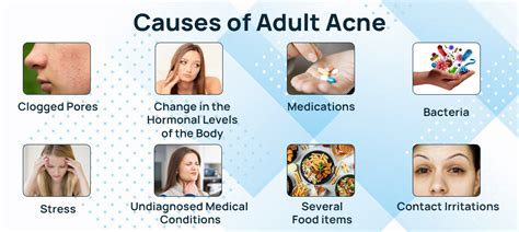 How To Treat And Prevent Adult Acne 24x7 Pharma