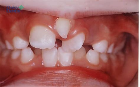 Răng Thừa Là Gì Nguyên Nhân Và Cách Khắc Phục Răng Dư Thừa