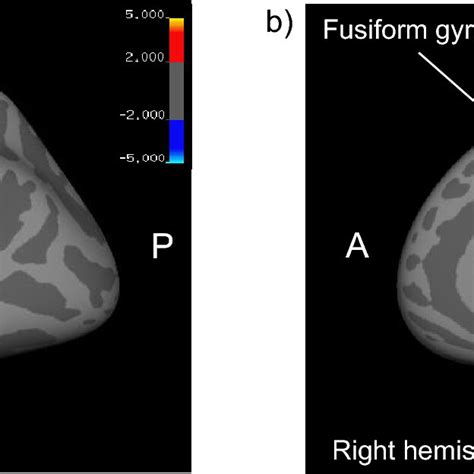 Result Of Voxel Wise Analysis For Performance Anxiety Levels A The