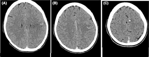 Brain Ct Scan Without And With Injection Left Parietal Hypodensity Download Scientific