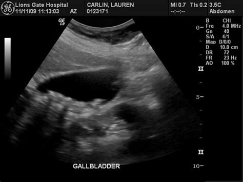 BILIARY COLIC SYMPTOMS BILIARY COLIC BILIARY COLIC SYMPTOMS WHAT