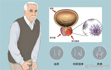积医科普｜保护“生命腺”，警惕男性的“沉默杀手”——前列腺癌