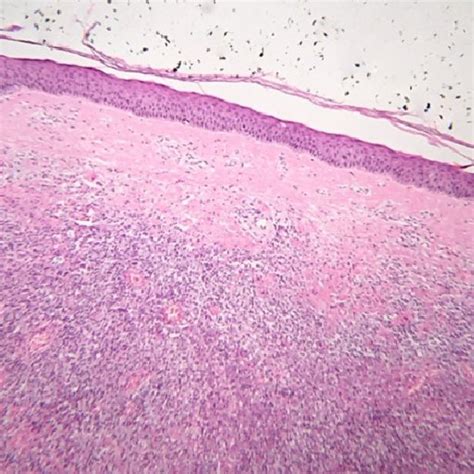 Vesiculopustular Lesions Over All Four Limbs And Trunk For The Past 10