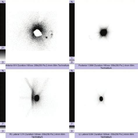 Traditional Breast Lymphoscintigraphy Technique With 57co Backlighting