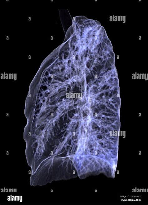 Ct Chest Or Lung 3d Rendering Image Showing Trachea And Lung In