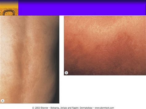 Connective Tissue Diseases Ppt Video Online Download