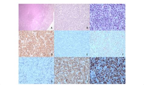 Histopathological Features Of Plasma Cell Neoplasm With Pleomorphic Download Scientific Diagram