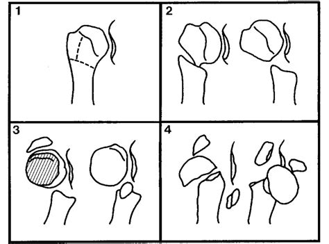 The Neer Classification Of Fractures Of The Surgical Neck Of The Neer Classification Of Fractures Of The Surgical Neck Of