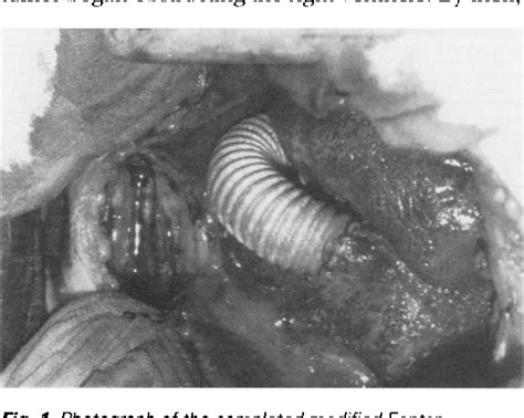 Figure 1 From Cardiac Sarcoma Semantic Scholar
