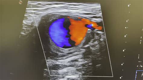 Video Rowan Paul Md On Linkedin Always Use Colorpower Doppler