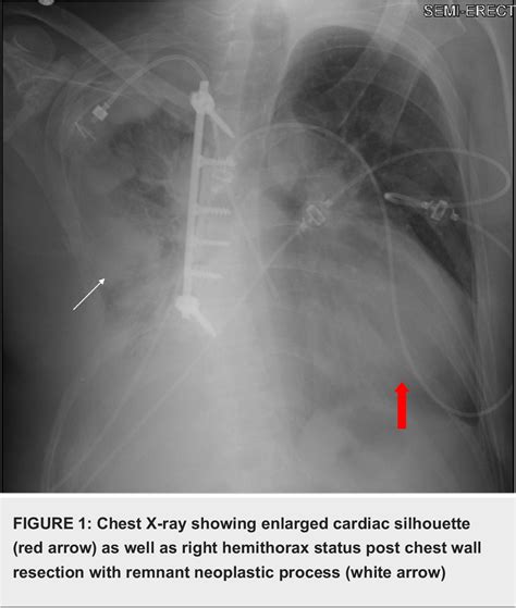 Figure 1 From Effusive Constrictive Pericarditis In A Young Active Duty