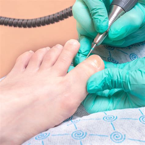 Get Rid Of Ingrown Toenails Now Midwest Podiatry Centers