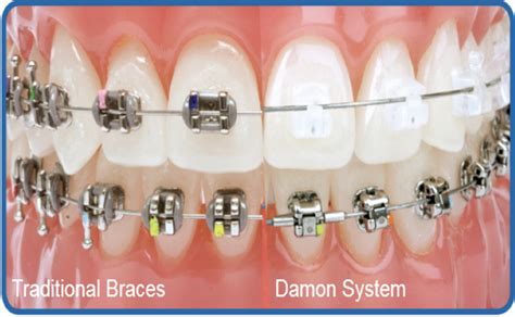 Chisel Dental Clinic Blog At Chisel Dental Clinic We Are Proud Of